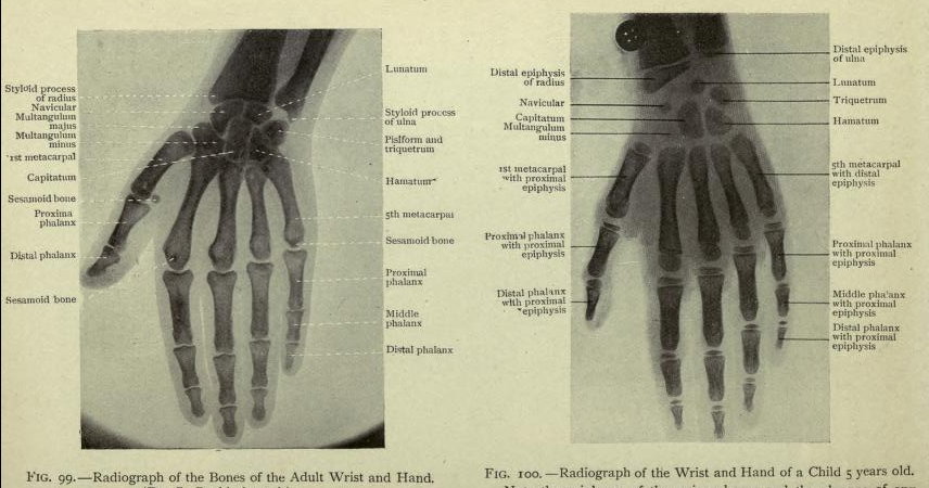 ‘Radiograph of the Bones of the Adult Writs and Hand / Radiograph of ...